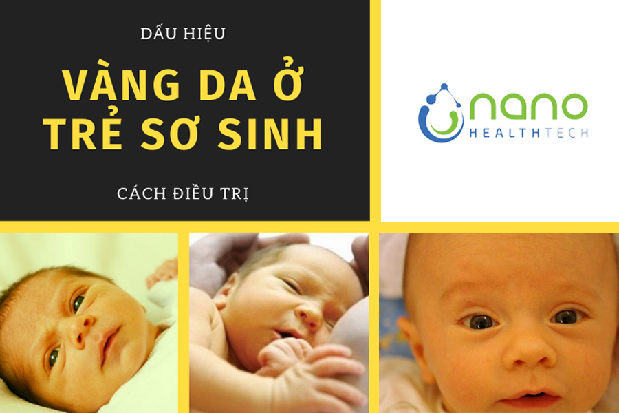 Vàng da ở trẻ sơ sinh: Nguyên nhân, dấu hiệu và cách điều trị